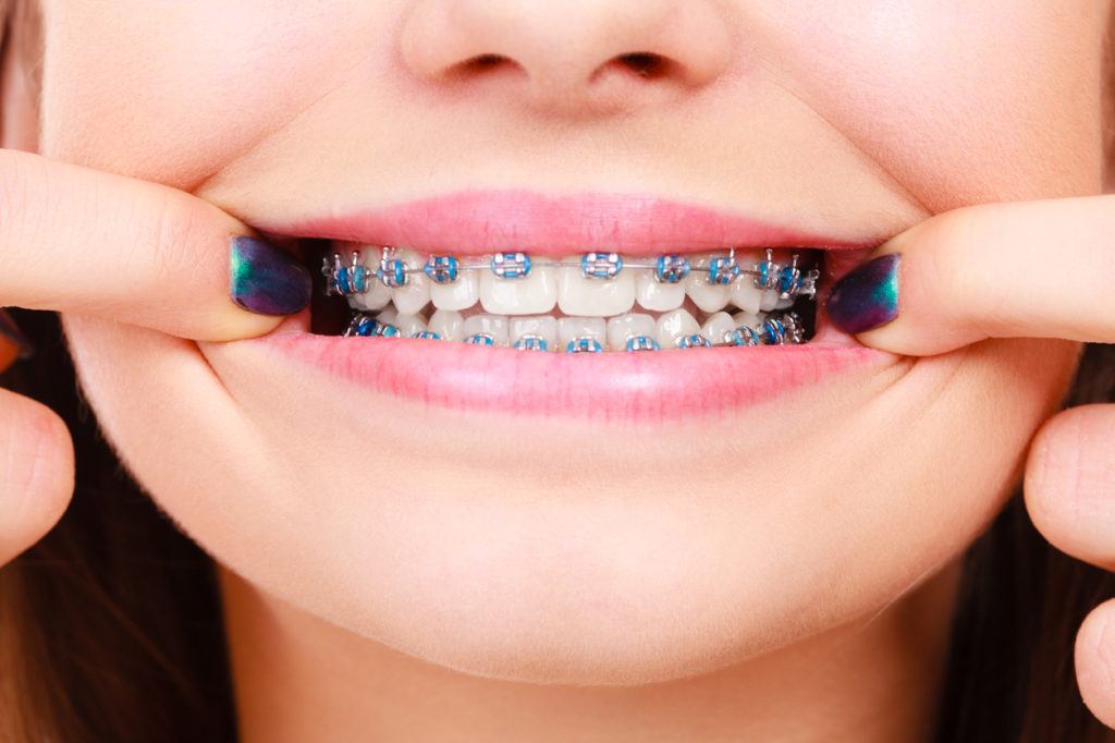 Types of Braces: Metal, Clear & Aligners to Fit Your Smile